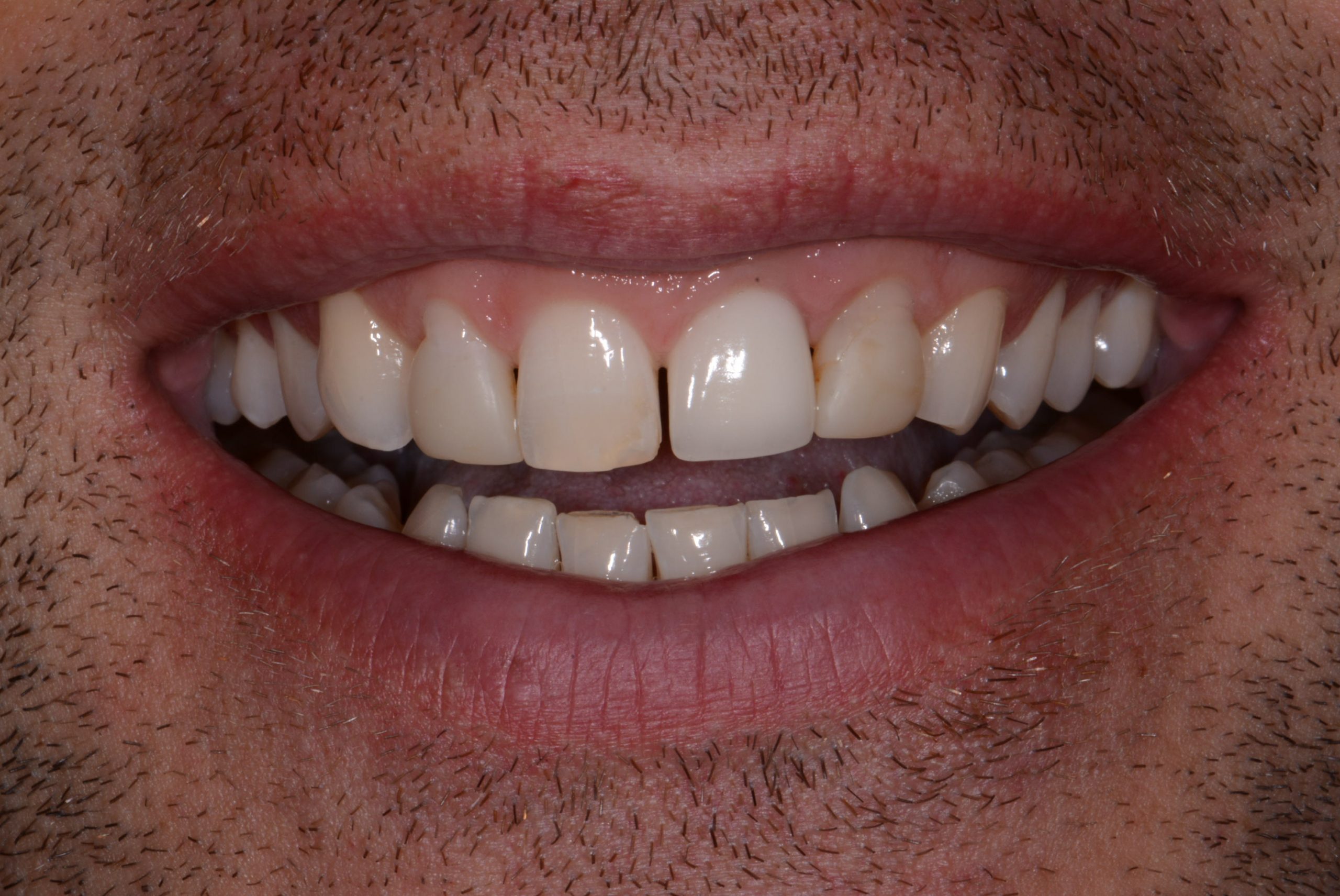 Smile Gallery - Real patients, real smiles | Duvall, WA